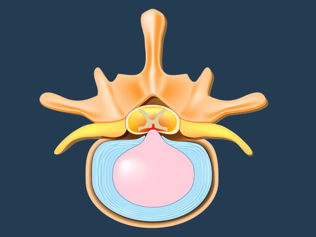 How Spinal Decompression Therapy Can Help Heal Disc Injuries - TexStar ...